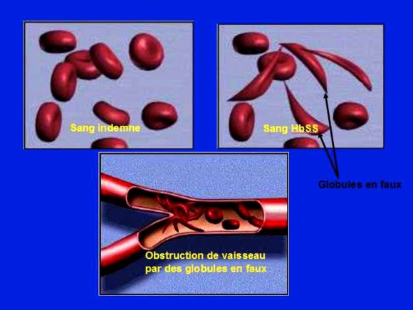 LA DREPANOCYTOSE | Docteur Alovor